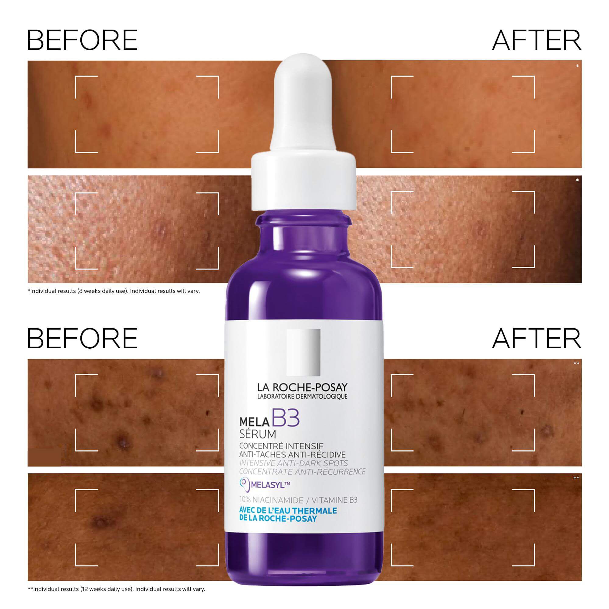 Mela B3 Intense Anti-Dark Spot Serum | Post Acne marks | La Roche-Posay UK